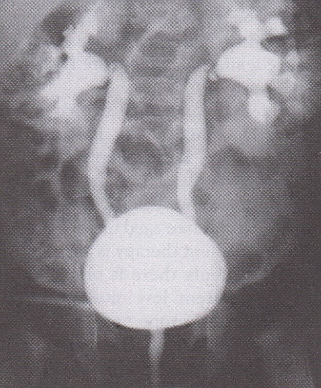 Reflux Nephropathy in Children – UK Kidney History