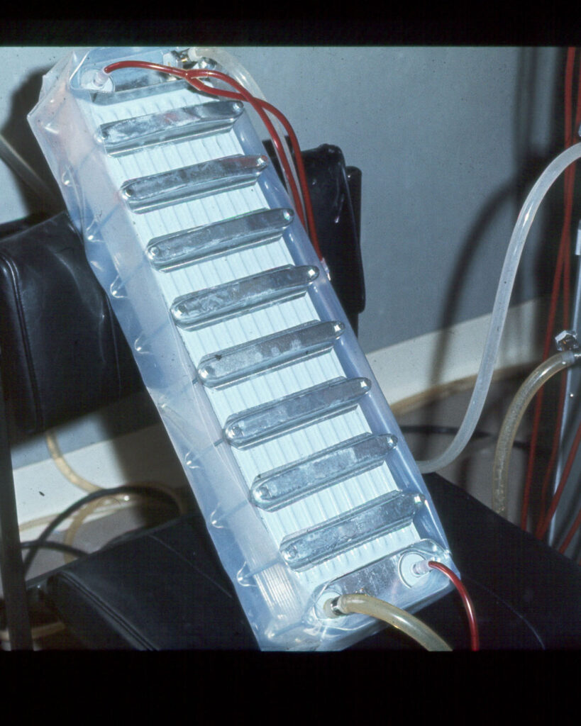 Dialysis technology in the UK 1960-2005 – UK Kidney History
