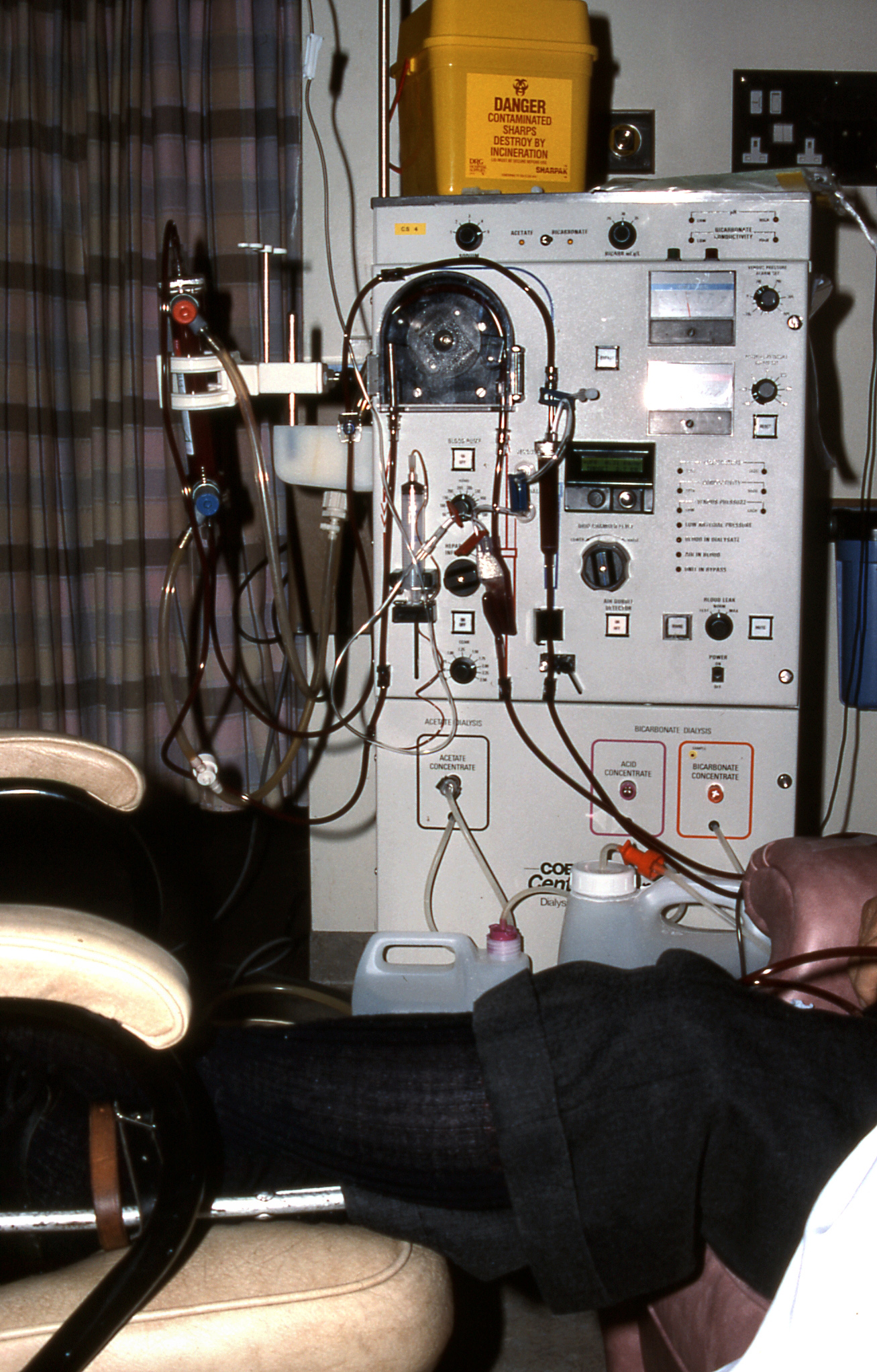 Dialysis technology in the UK 1960-2005 – UK Kidney History